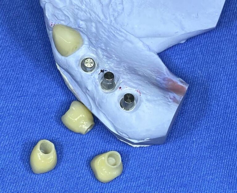 Heavy is the Head that Holds the Crown: Zirconia vs. Traditional ...